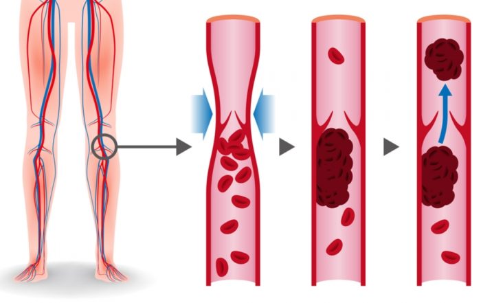 DVT | Health Library | Qoctor your quick online doctor