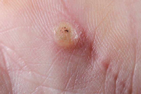 How to treat warts- what actually works? - Qoctor your quick online doctor